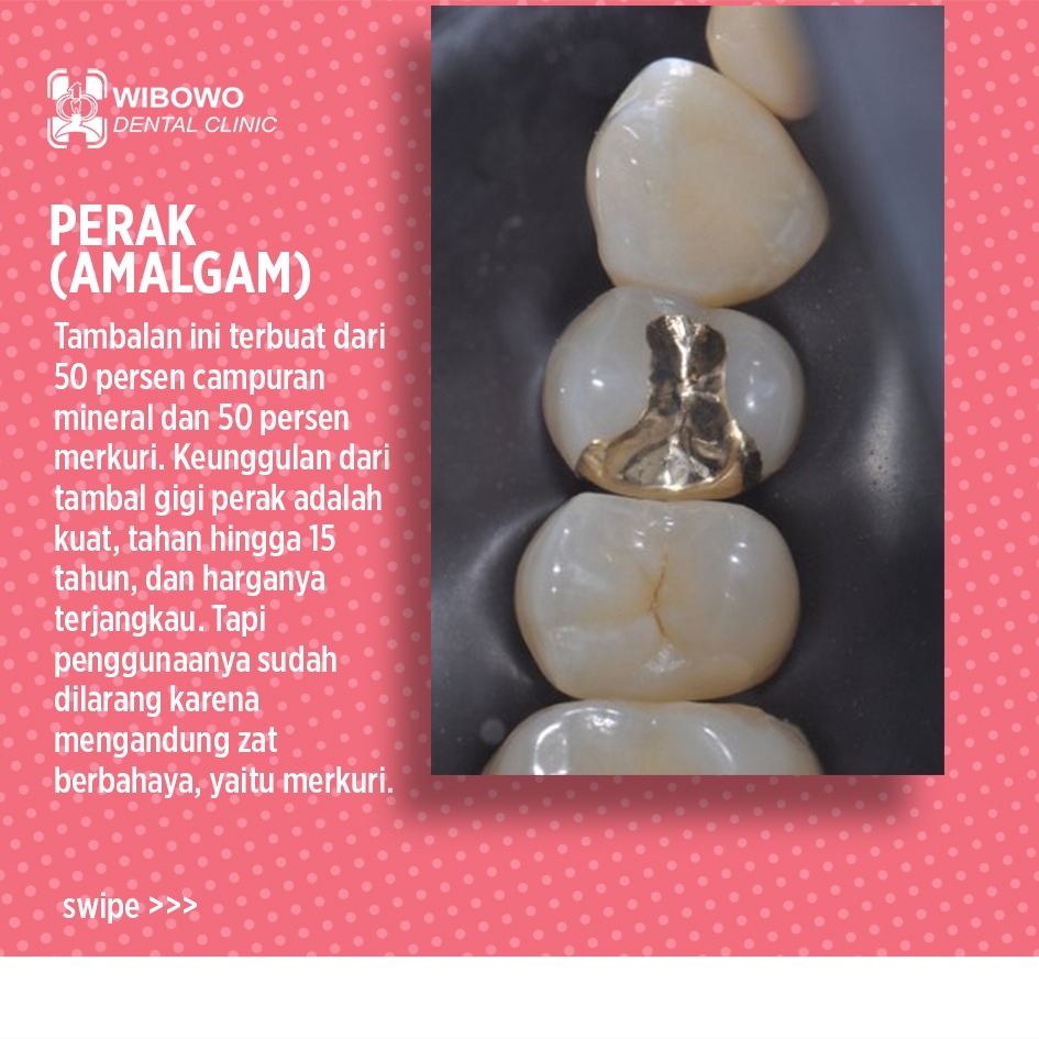 Tambalan Gigi, Ini Jenis dan Biaya Pemasangannya - Implan Gigi Surabaya