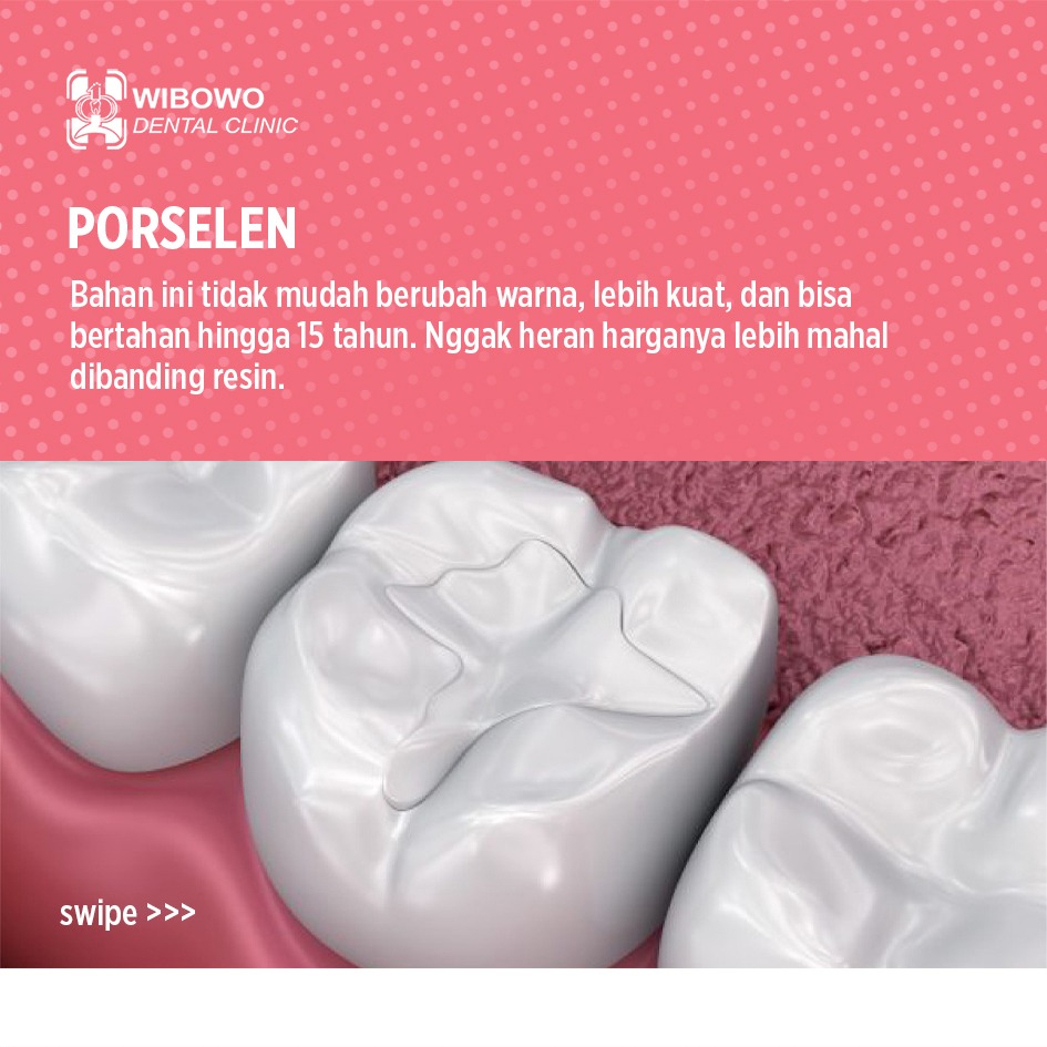 Tambalan Gigi, Ini Jenis dan Biaya Pemasangannya - Implan Gigi Surabaya